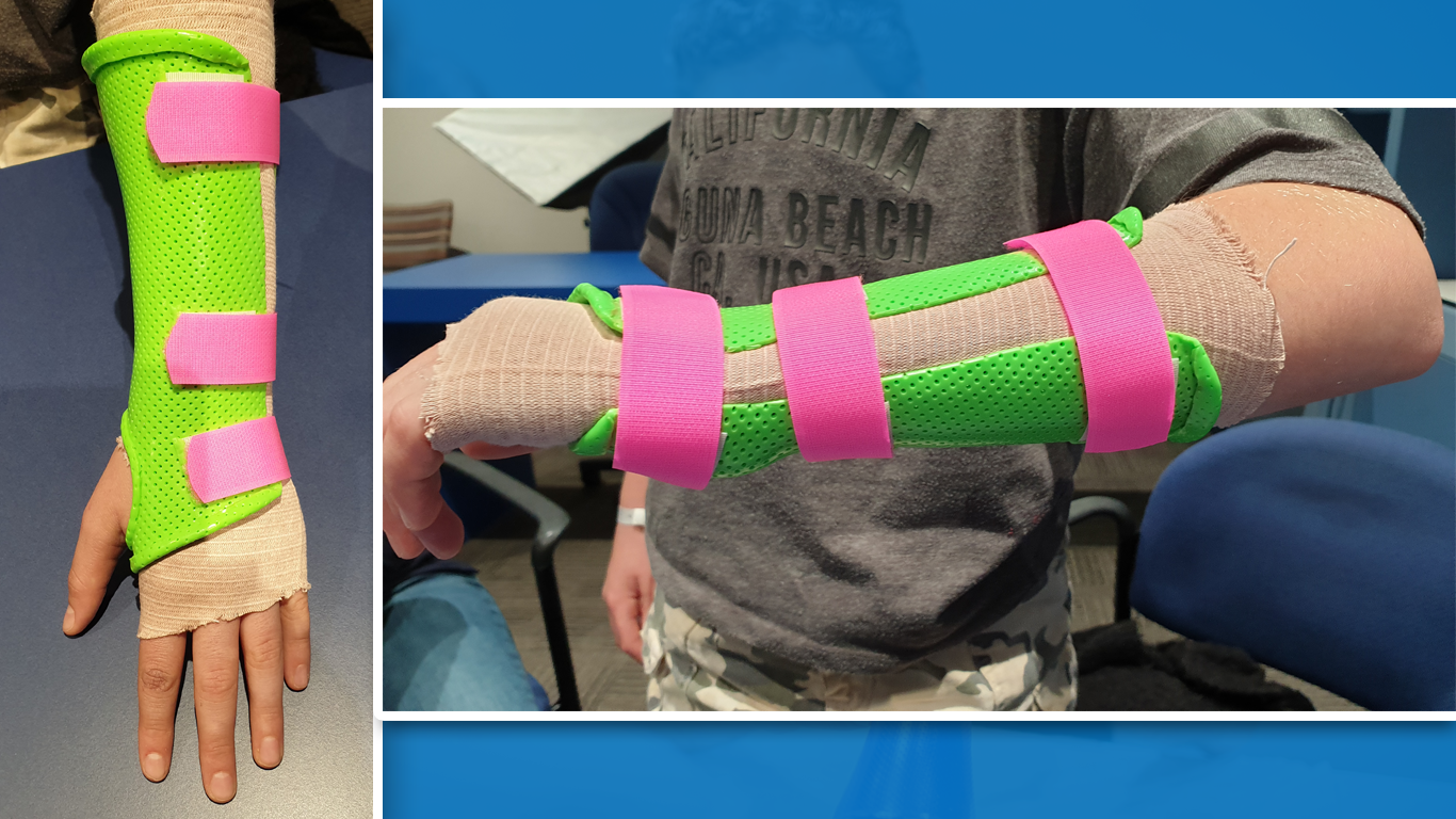 Case Study - Scaphoid Fracture Flex Physio