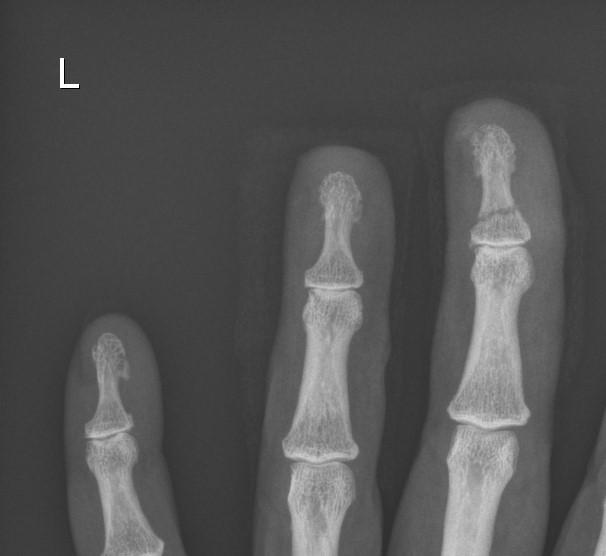 Case Study - Transverse Fracture Flex Physio