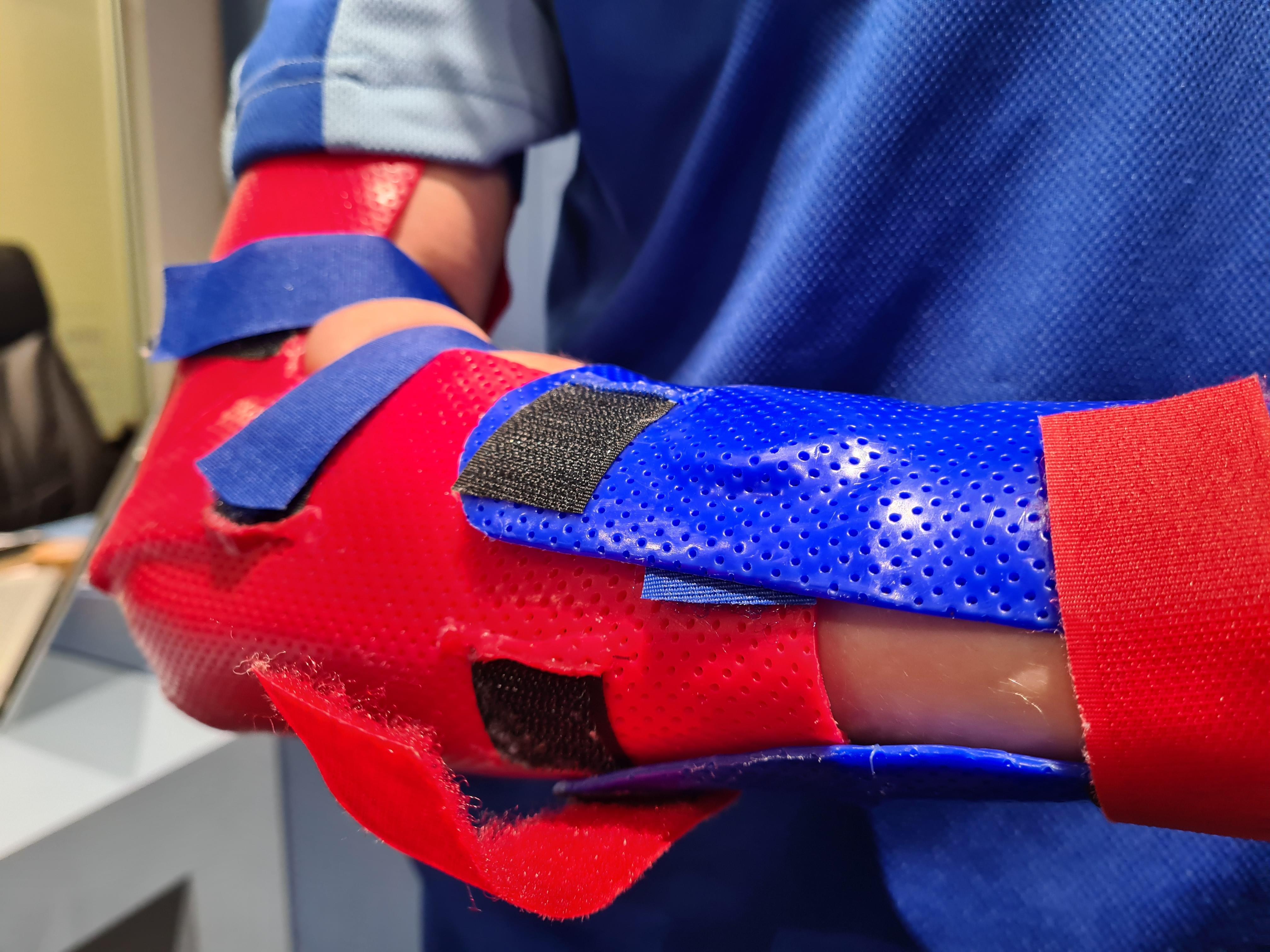 Case Study - Greenstick Fracture Flex Physio